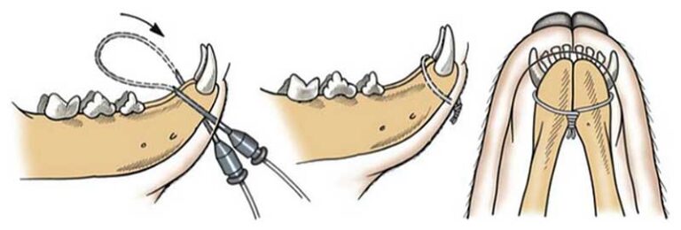Treating mandibular symphyseal separation