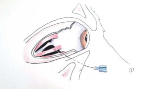 A look at analgesia for enucleation